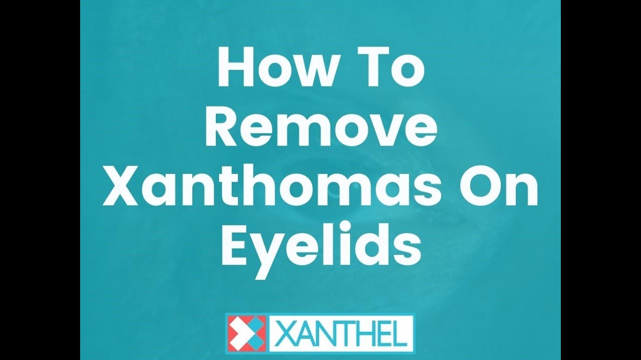 How To Remove Xanthomas On Eyelids ? Its easy when you know how ! - By ...