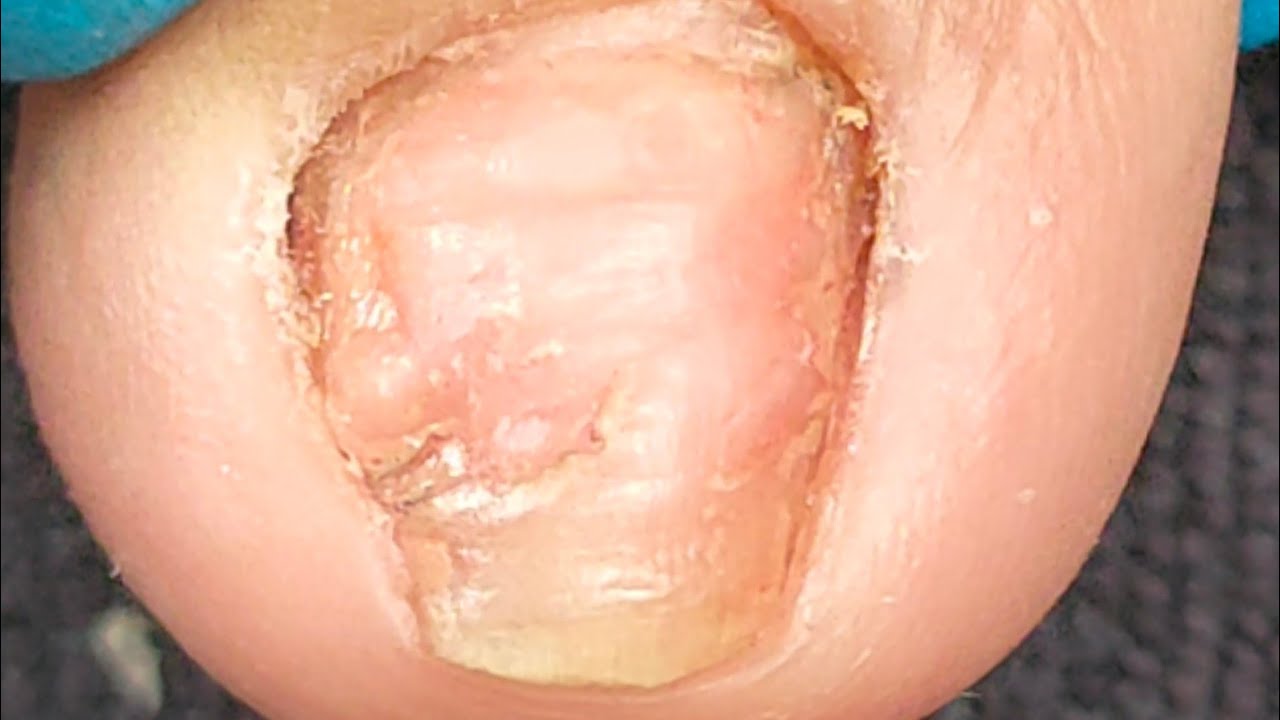 The hidden nail makes the toe become sensitive - YouTube