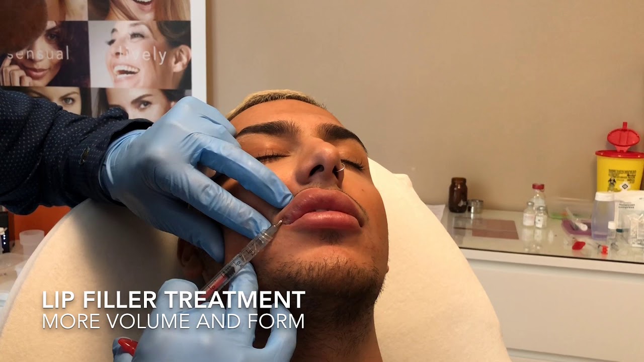 Lip filler treatment big volume (man) | Blush injectables by doctor ...