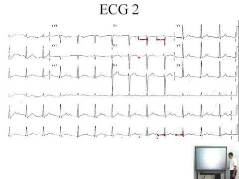Dossier PAE - Cardiologie 09 - YouTube