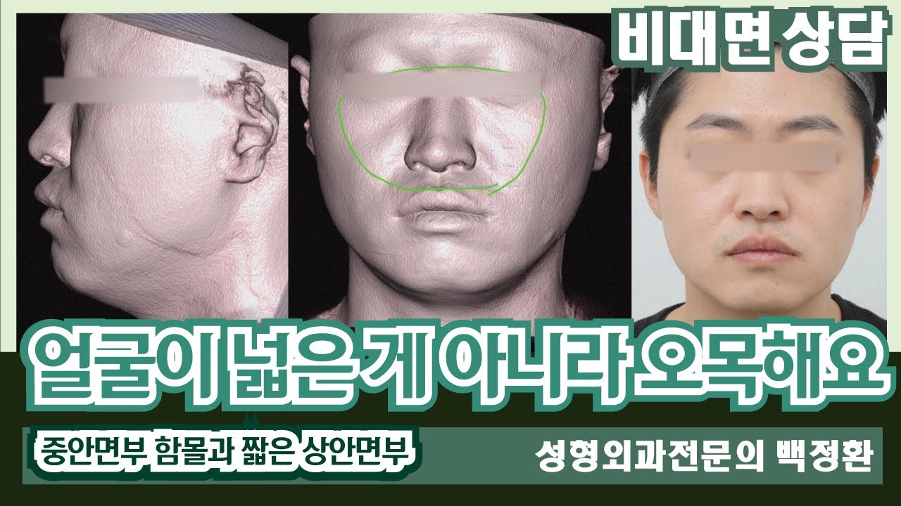 (SUB) 얼굴이 넓은 게 아니라 오목해요 [비대면상담 440] / The face is not wide but concave ...