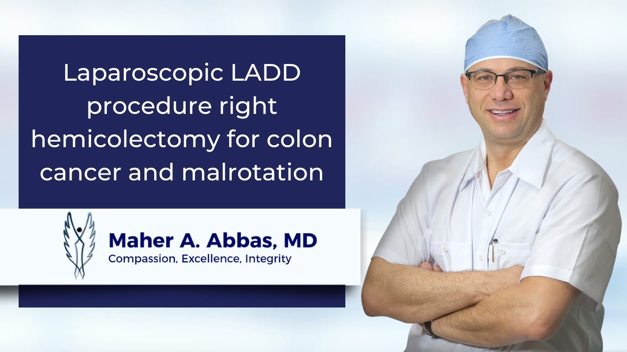 Laparoscopic LADD procedure right hemicolectomy for colon cancer ...
