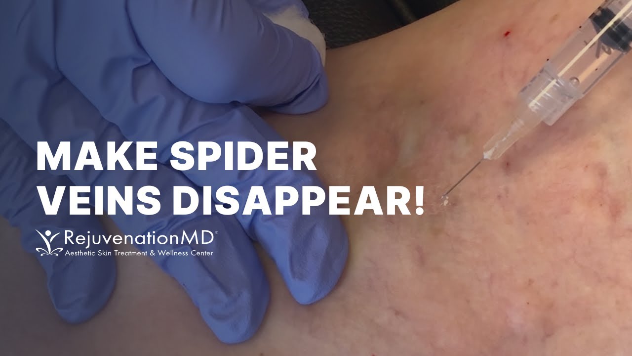 Watch Spider Veins Vanish! Asclera Vein Treatment - YouTube
