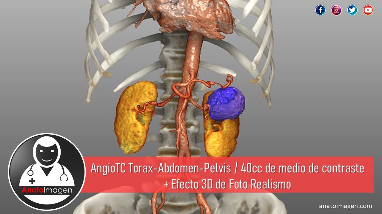 Angio Tomografía de Tórax Abdomen y Pelvis - Efecto Foto Realista - YouTube