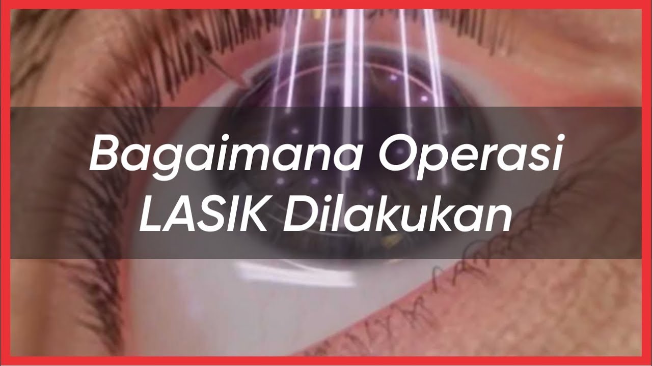 Bagaimana Operasi LASIK pada mata Minus dilakukan? - YouTube