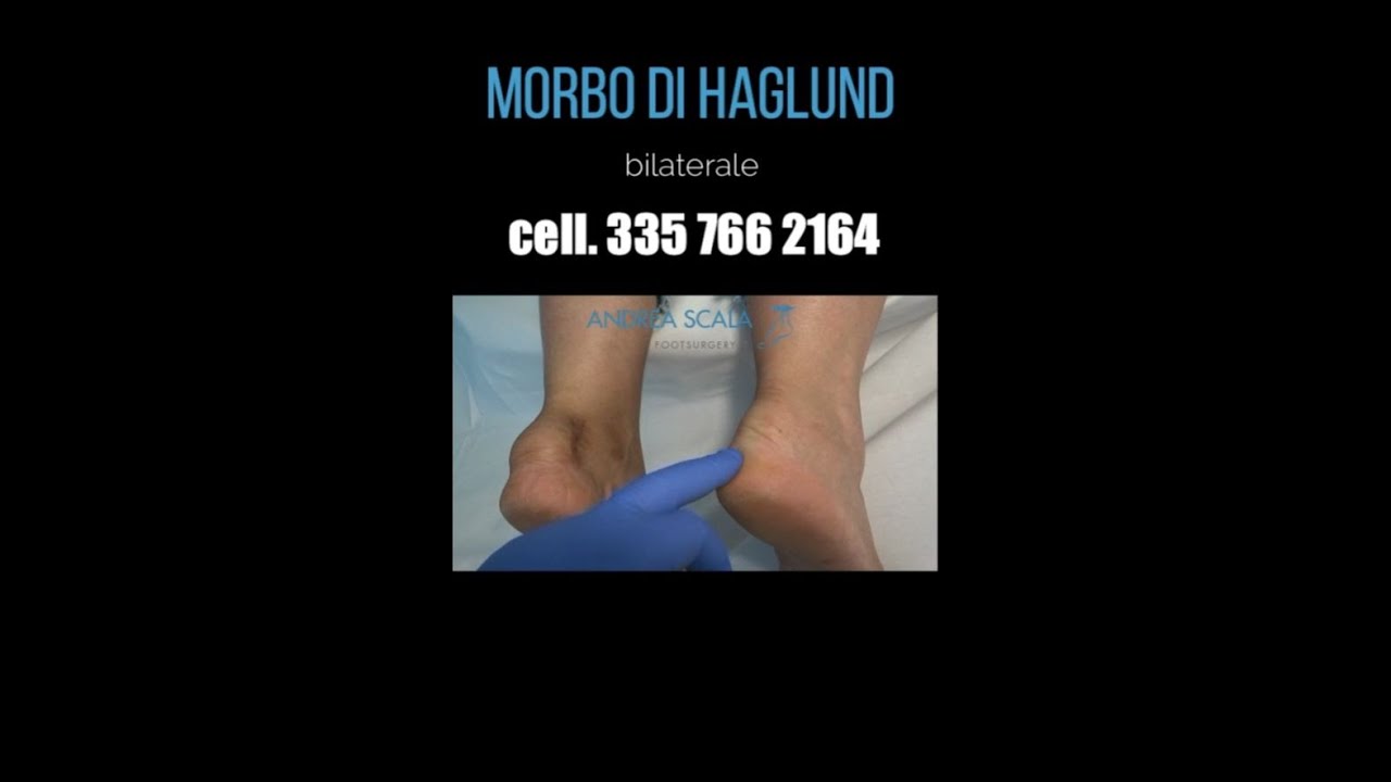 Haglund bilaterale | Malattia di haglund intervento chirurgico | Dott ...