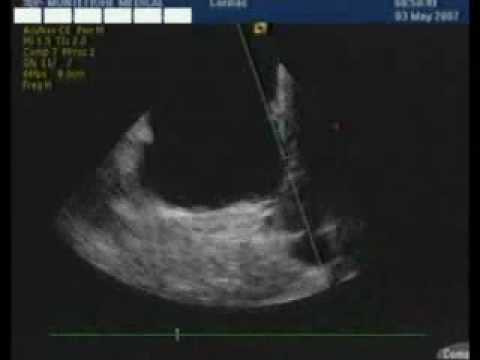 intracardiac echocardiography (ICE) - YouTube