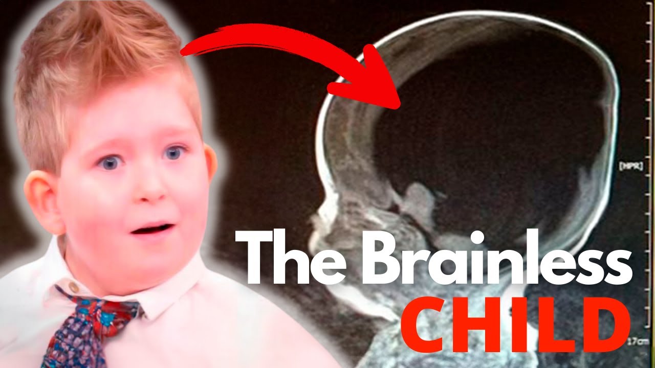 Can we LIVE without a BRAIN? | The CASE of NOAH WALL and 3 Others May ...