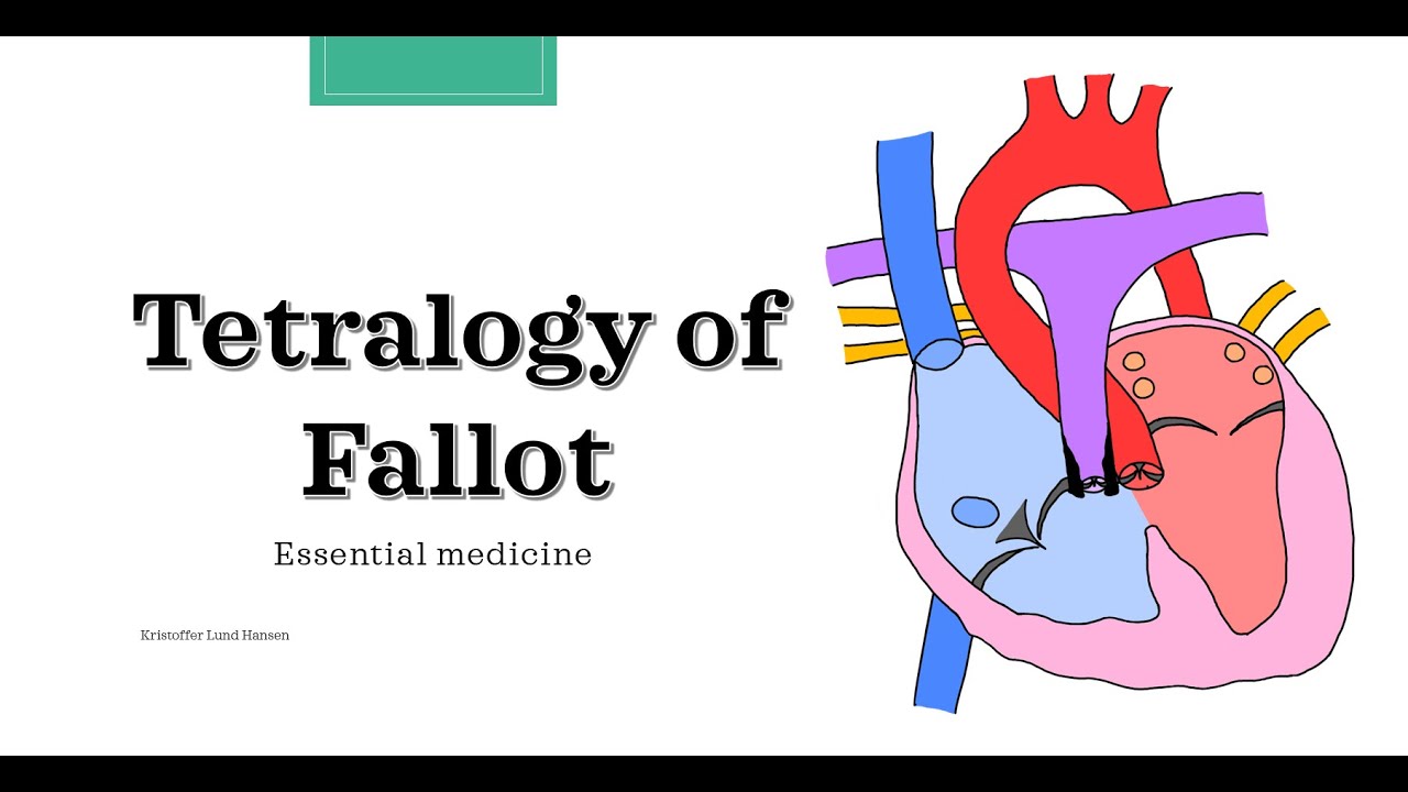 Tetralogy of Fallot [Essential medicine] - YouTube