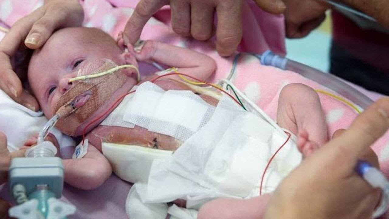 Baby Survives Surgery After Being Born With Heart Outside Chest - YouTube