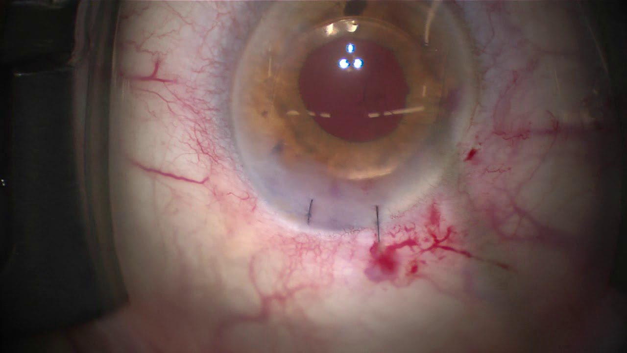 PCIOL explantation, clear cornea posterior vitrectomy attempt, ACIOL OS ...