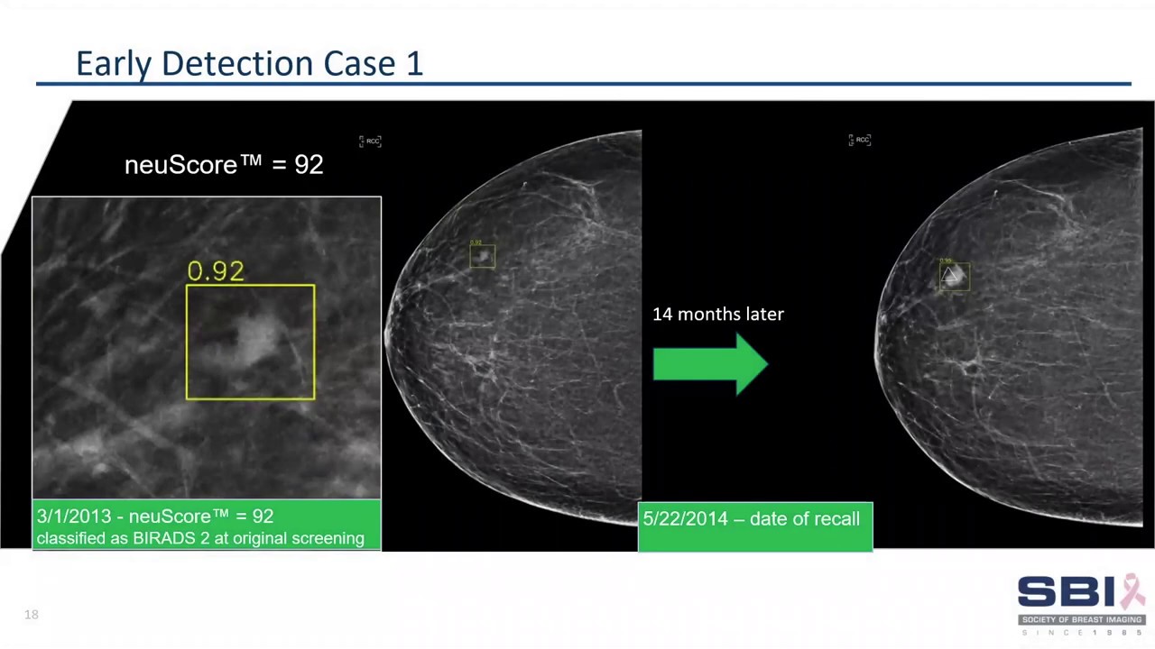 Mammography Workflow Reduction using Artificial Intelligence Based ...