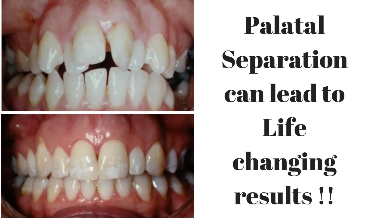 Palatal Separation can lead to Life changing results !! - YouTube