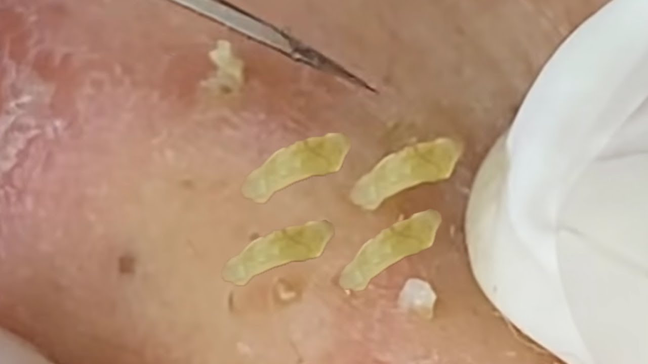Super blackhead extraction new this week,zits blackheads pimples,acne ...