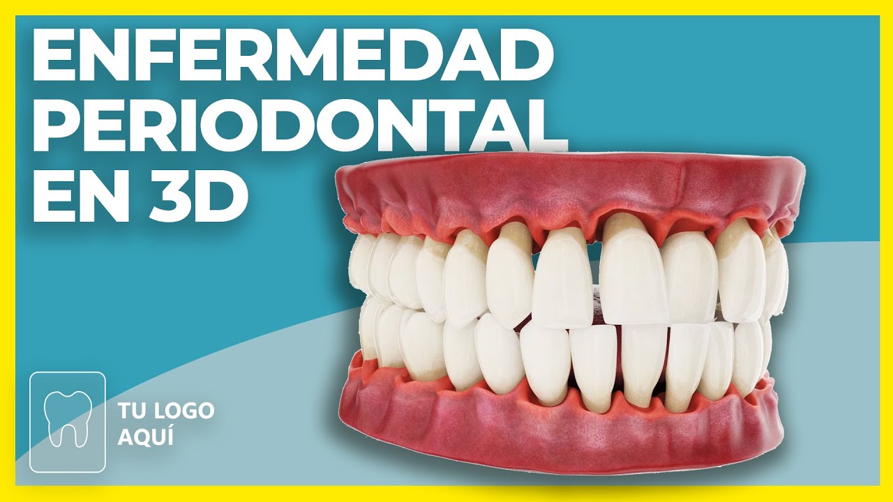 ENFERMEDAD PERIODONTAL 🦷 Vídeos de odontología en 3D - Animaciones 3D ...