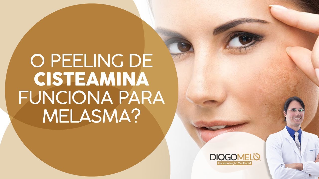 O Peeling de Cisteamina funciona para Melasma? - YouTube