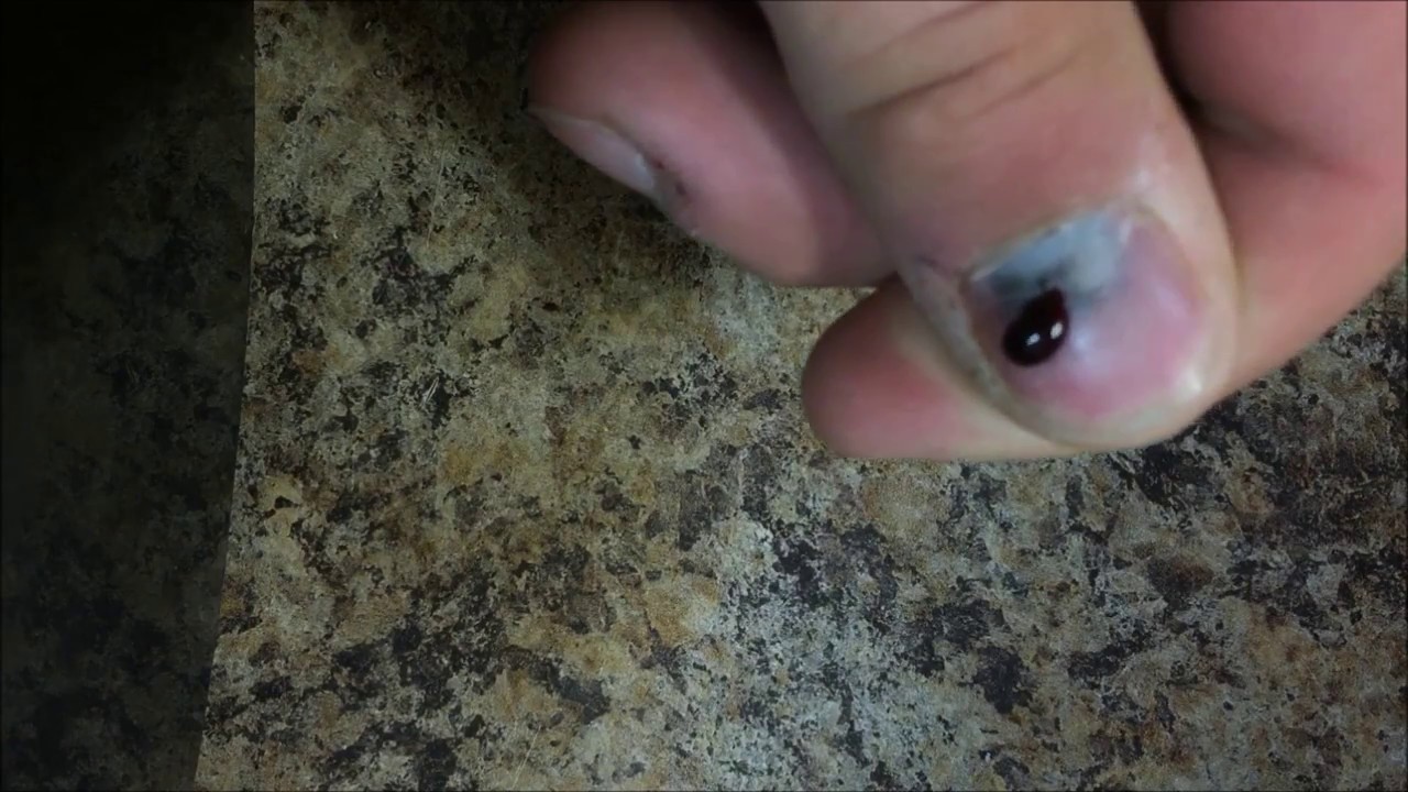 How to Drain a Blood Blister - YouTube