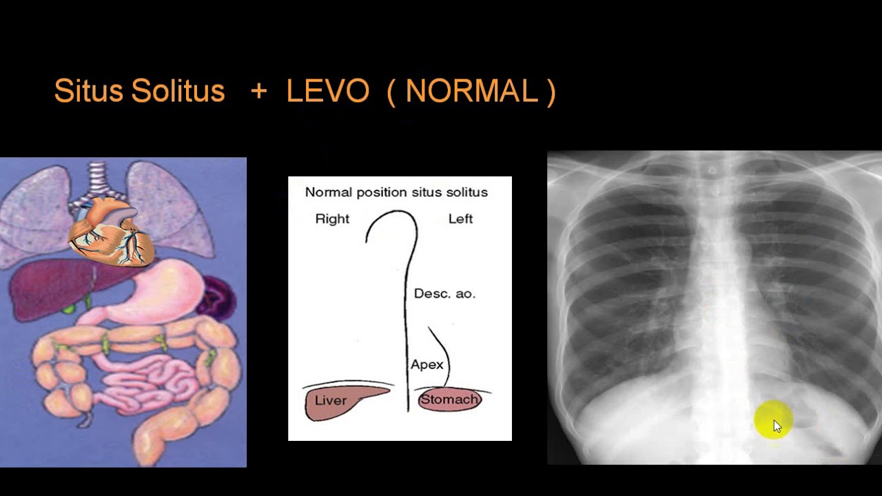 Situs Solitus Dextrocardia With Sinus Solitus | CMAJ