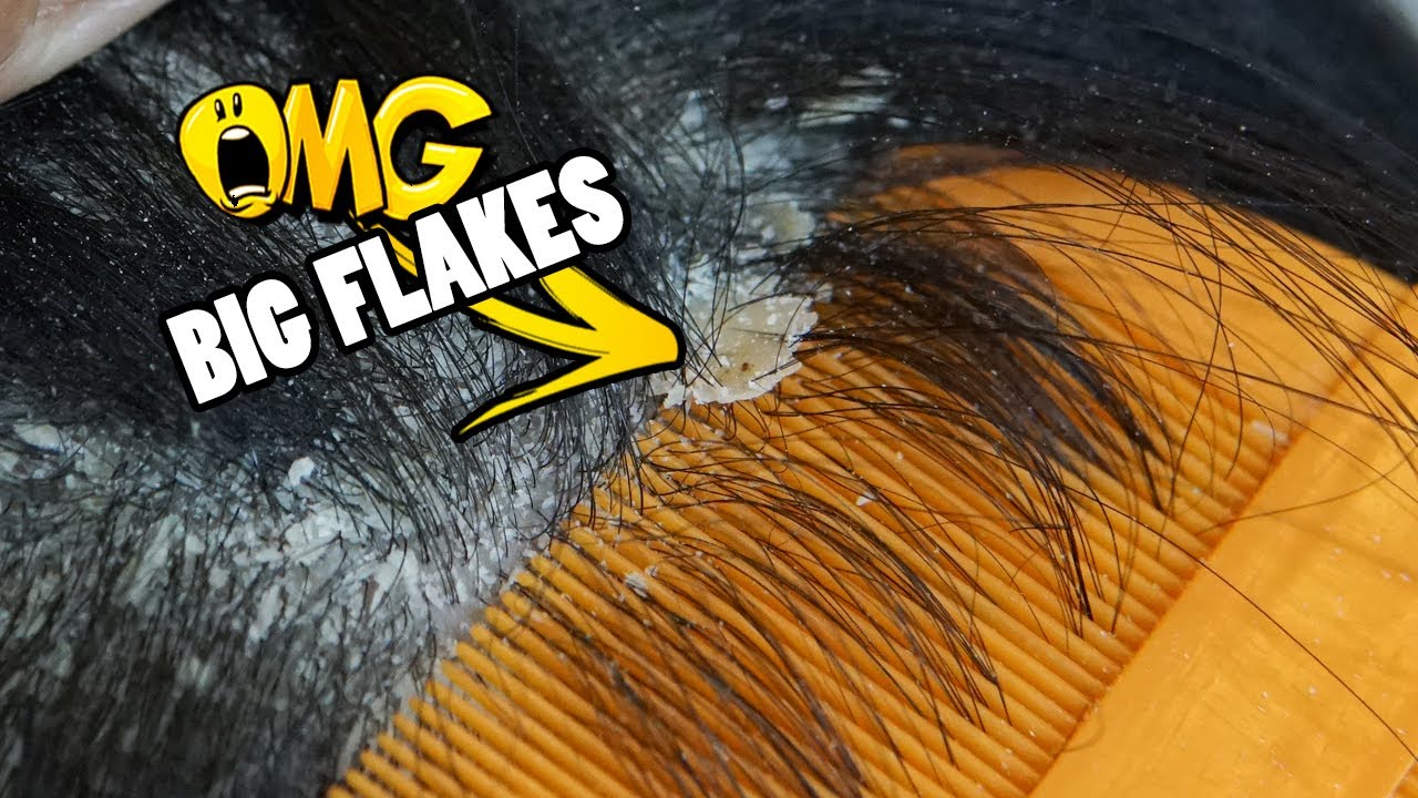 Scratching Dry Itchy Scalp!! Huge Dandruff Flakes Removal on Head With ...