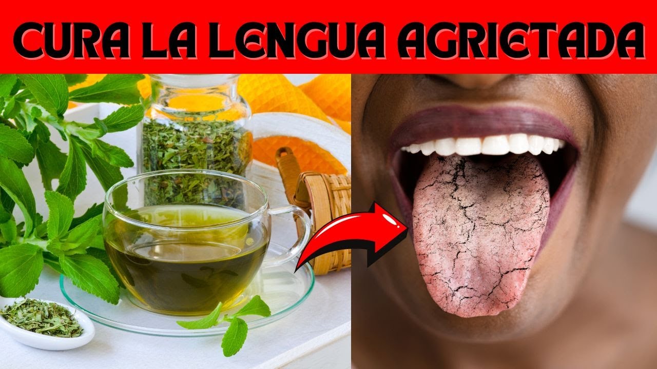 NUNCA MÁS LENGUA AGRIETADA! ELIMINA La LENGUA AGRIETADA Con PODEROSOS ...