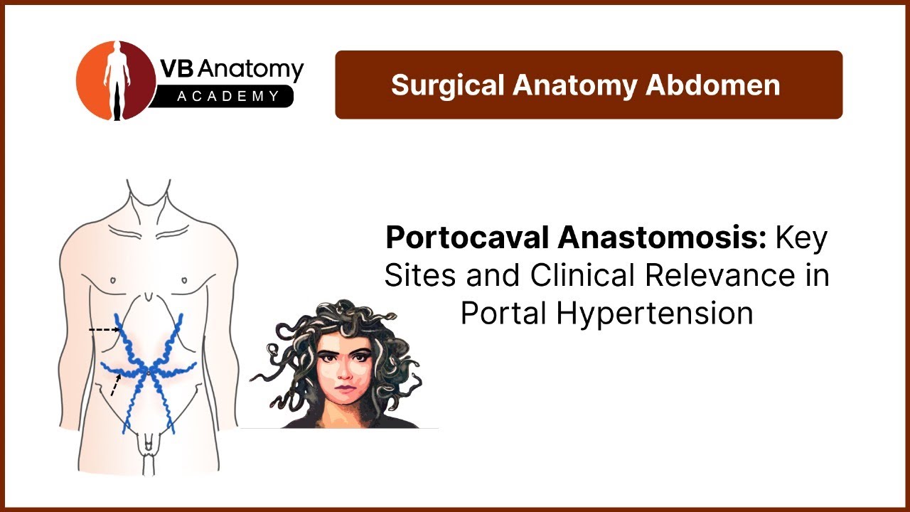 Portocaval Anastomosis: Key Sites and Clinical Relevance in Portal ...