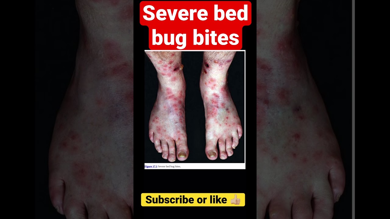 Severe bed bug bites - YouTube