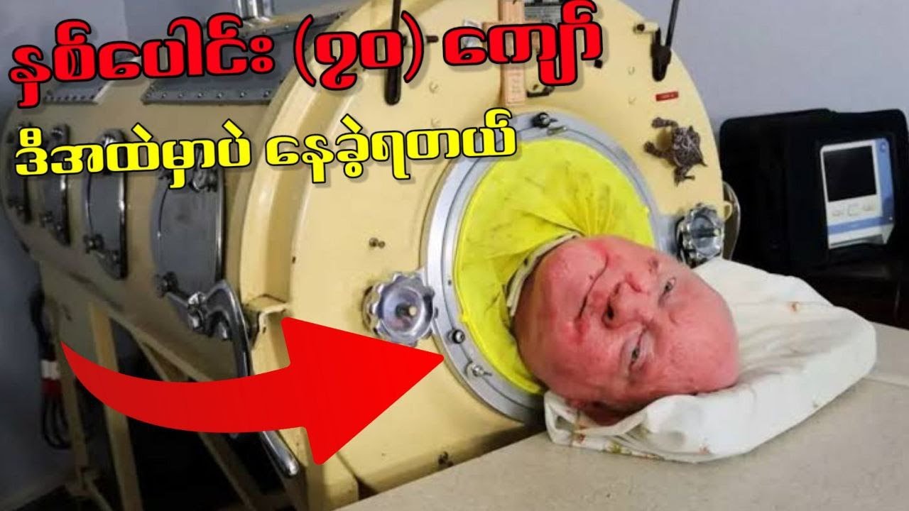 အဆုတ်မရှိပေမယ့် အသက် ၇၁နှစ်ကျော်အထိ အသက်ရှင်နေသူ/A person who has no ...