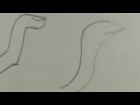 Deformity of the finger | Swan neck deformity - YouTube