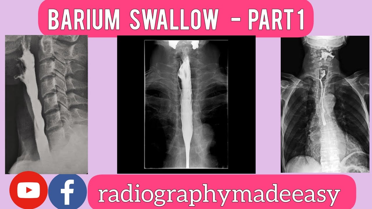 Barium Swallow || Part 1 || Clinical Indications || GIT System || By ...