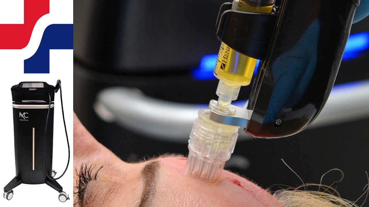 Mesotherapy with the Most Popular Automated Injector for HA, PRP & More ...