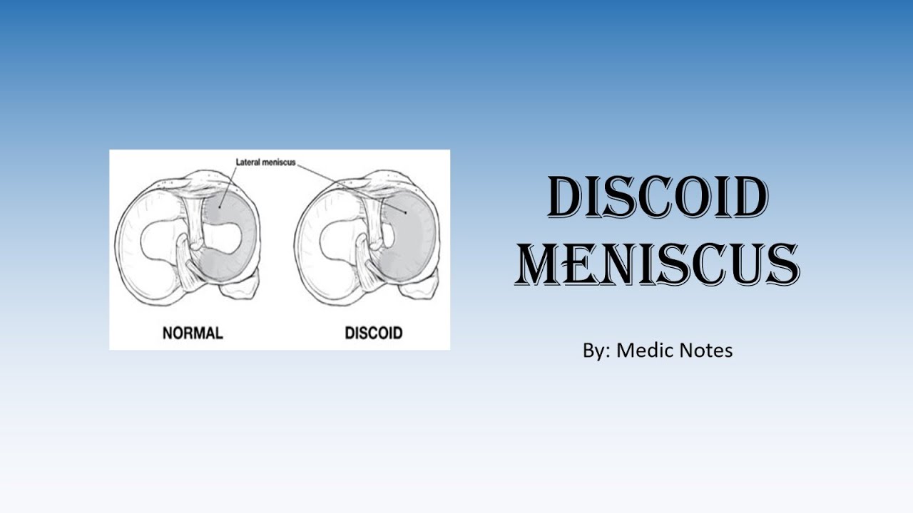 Discoid meniscus - signs and symptoms, imaging, treatment - YouTube