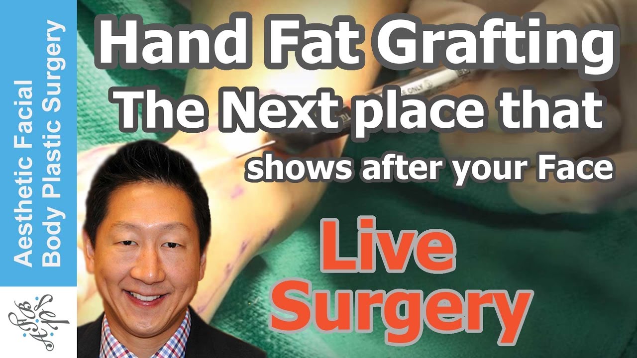 Fat injections of the Hand Live Video of Plastic Surgery by Dr Young of ...