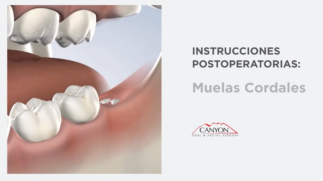 Instrucciones de Recuperación de Extracción de Muelas del Juicio en Las ...