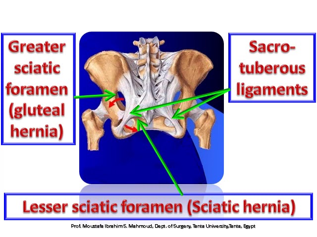 Sciatic Hernia