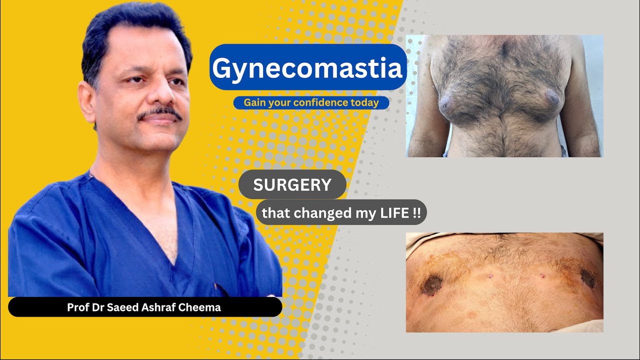 Gynecomastia. Why these cases need treatment. اپنے ان مريضوں کے احساس ...