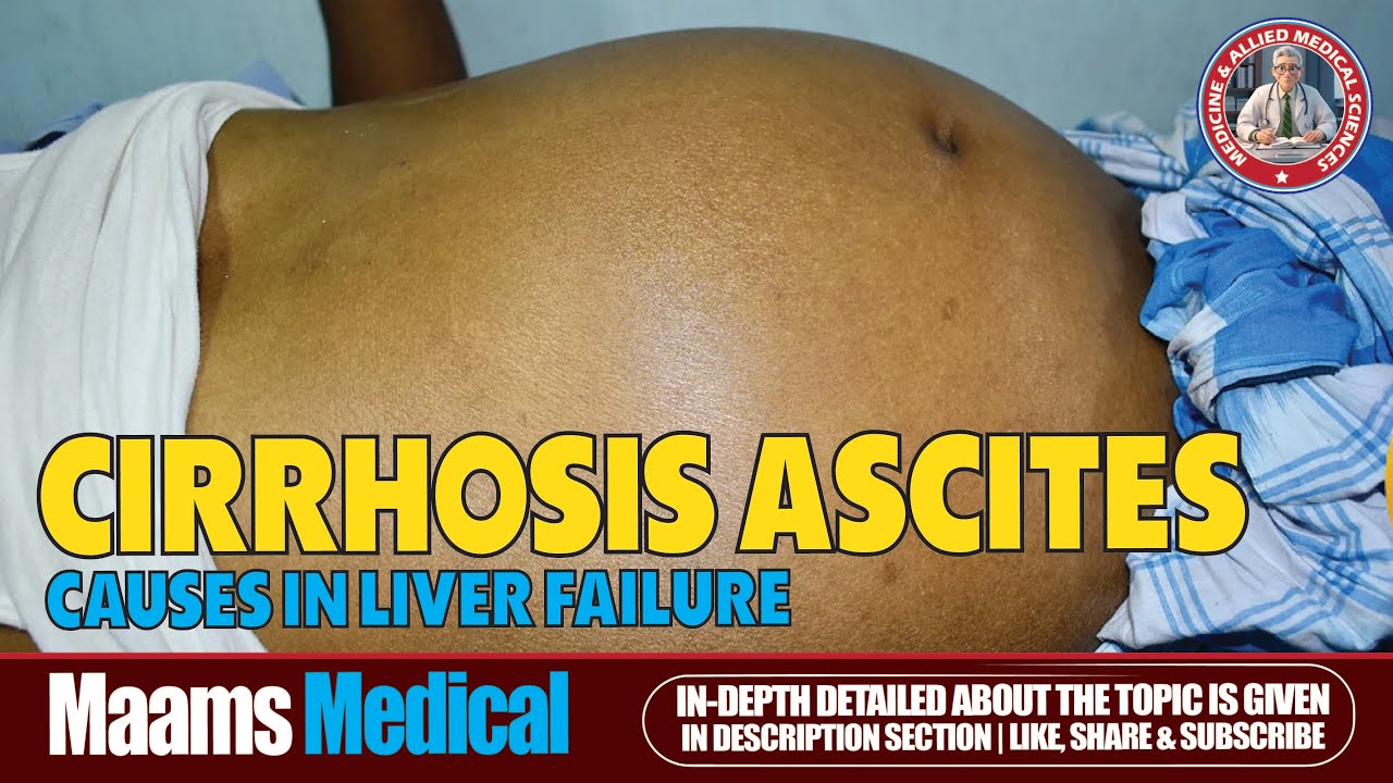 Ascites Fluid Buildup: Causes, Symptoms, and Treatment | Maams - YouTube