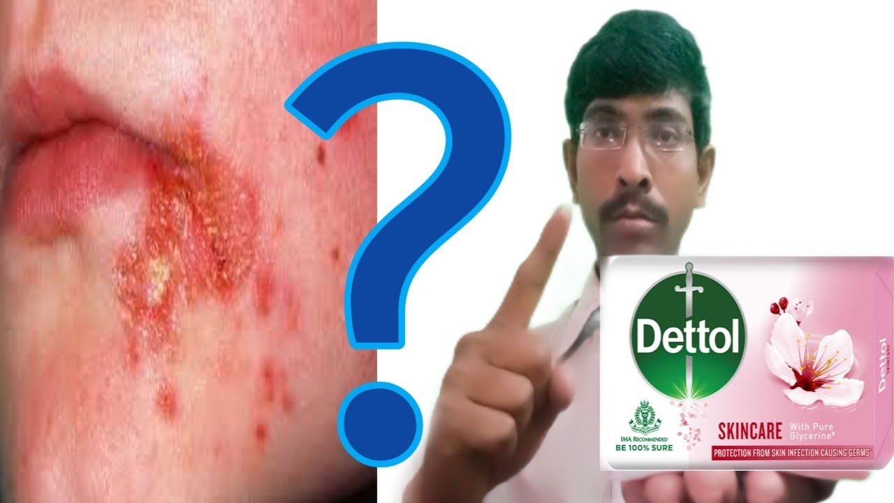 Dettol skincare soap review||Protection from skin infection ...