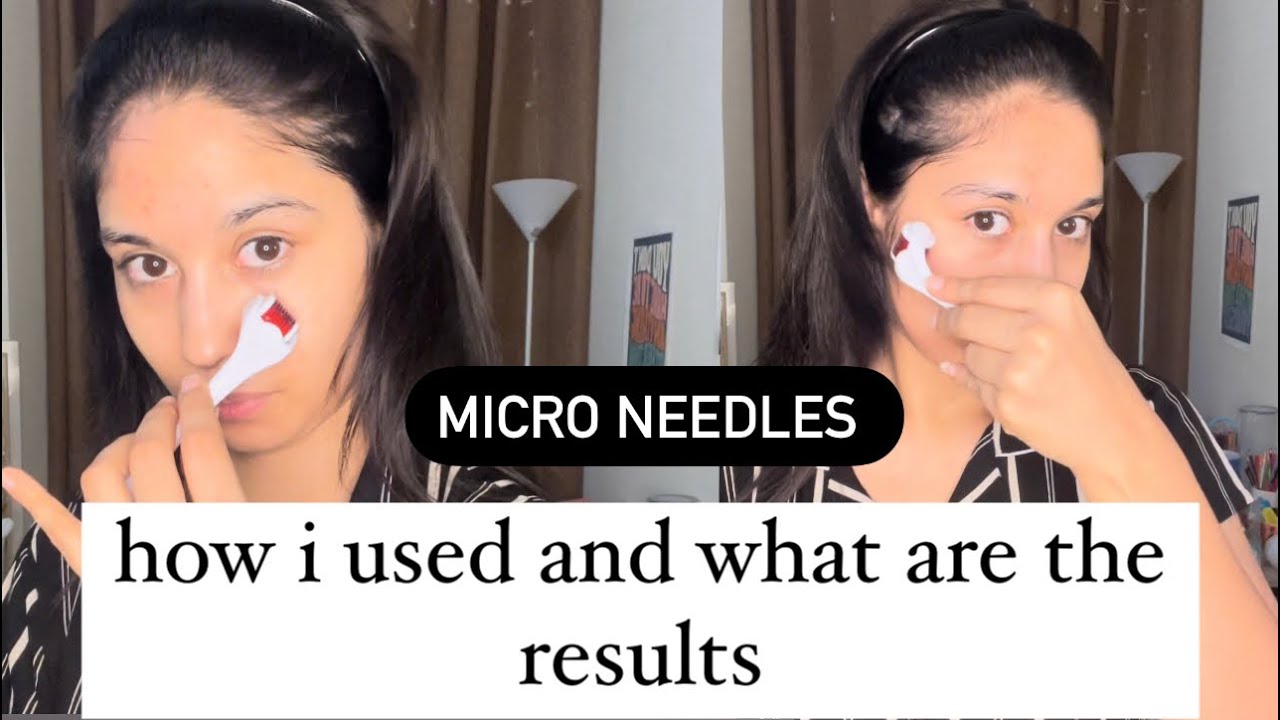 Micro needles | how to use | results - YouTube