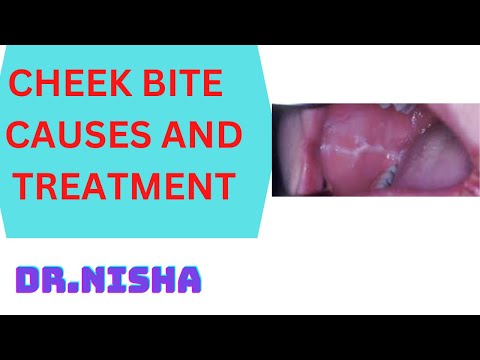 CHEEK BITE CAUSES AND TREATMENT || LINEA ALBA - YouTube