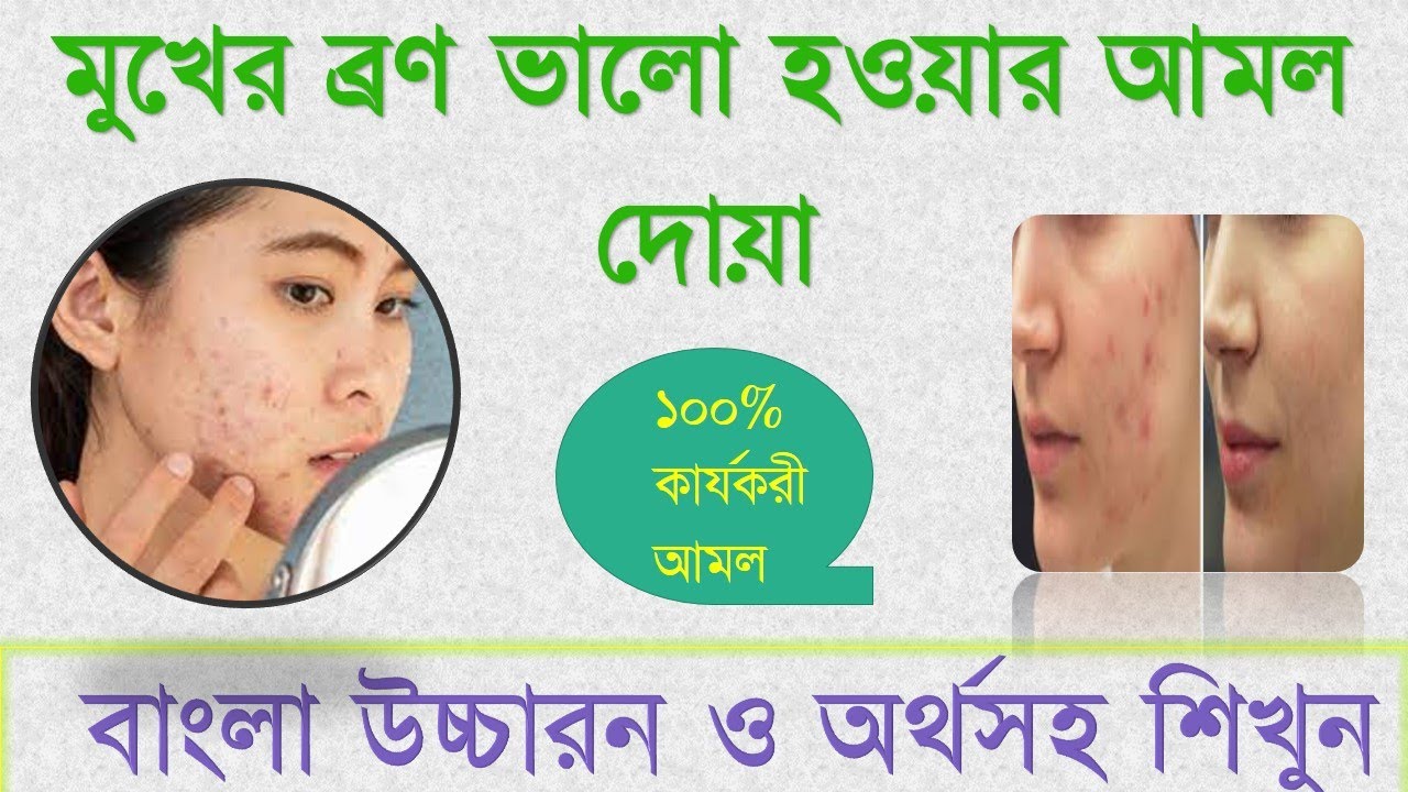 মুখের ব্রণ দূর করার উপায় আমল দোয়া চিকিৎসা ওষুধ || mukher bron dur ...