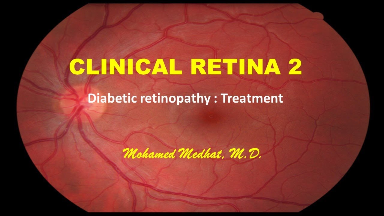 Clinical Retina 2 : Treatment of Diabetic retinopathy - YouTube