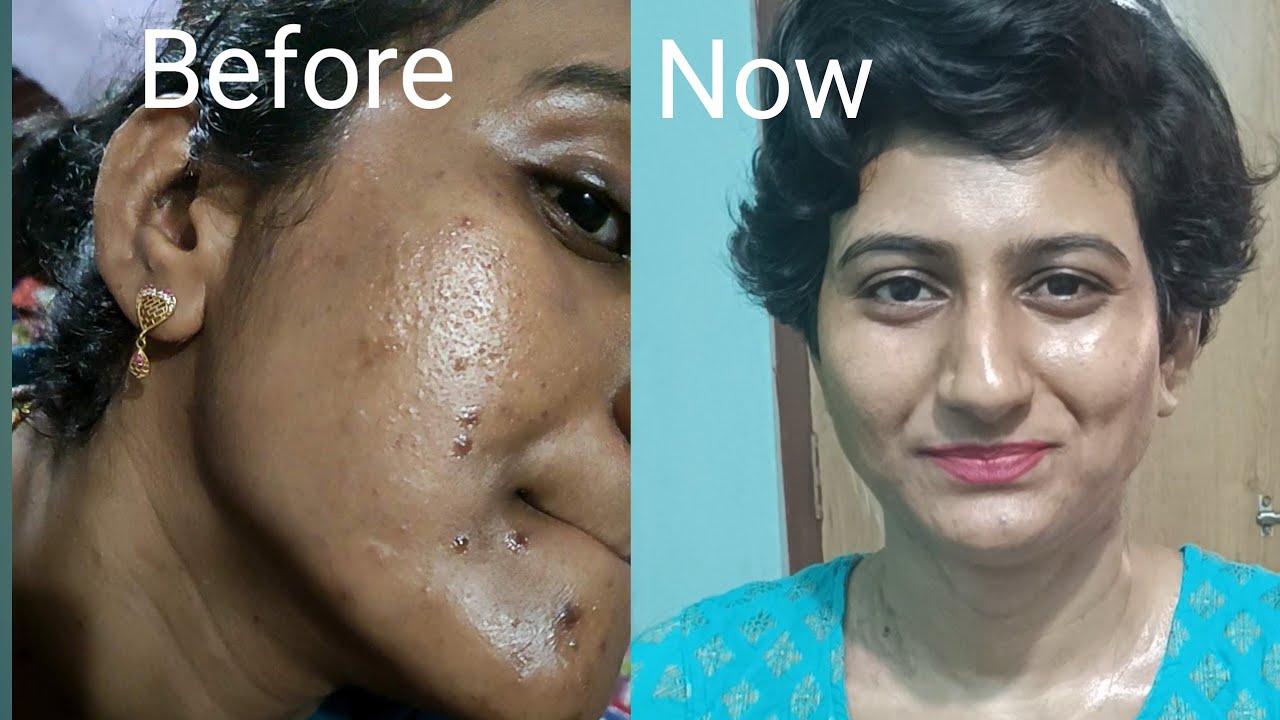 నా స్కిన్ ఇలా ఎలా మారింది? 😱 My Real Skin Transformation Journey in ...