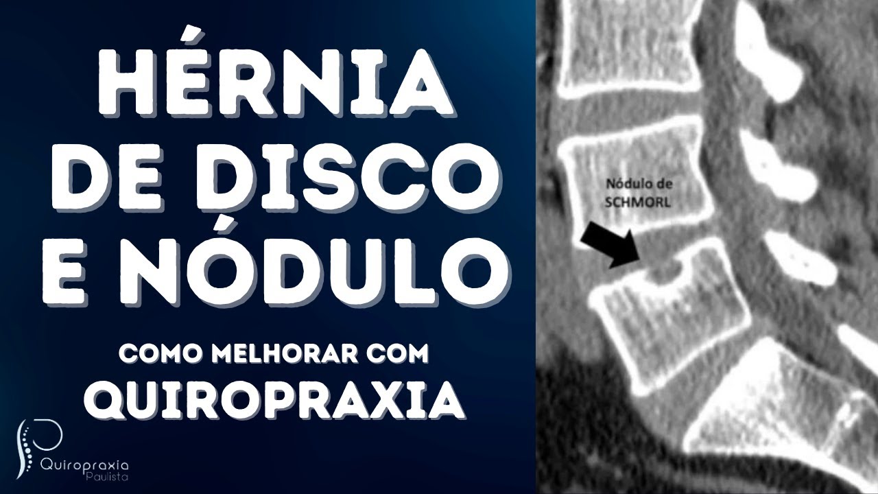 HÉRNIA DE DISCO E NÓDULO DE SCHMORL - YouTube