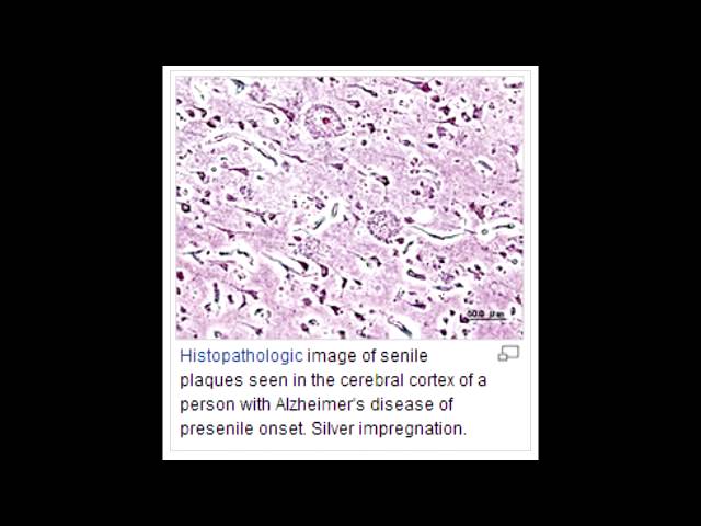 Senile Plaques Senile Plaque An Overview | ScienceDirect Topics