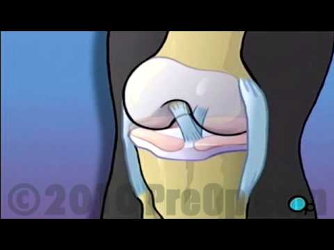 Arthroscopic Meniscus Repair of Knee PreOp® Patient Education - YouTube