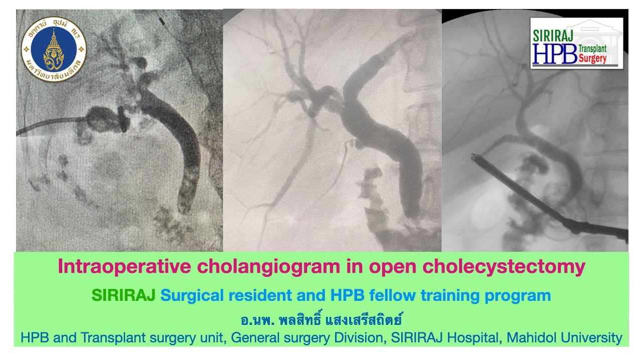 Intraoperative cholangiography in open cholecystectomy - YouTube