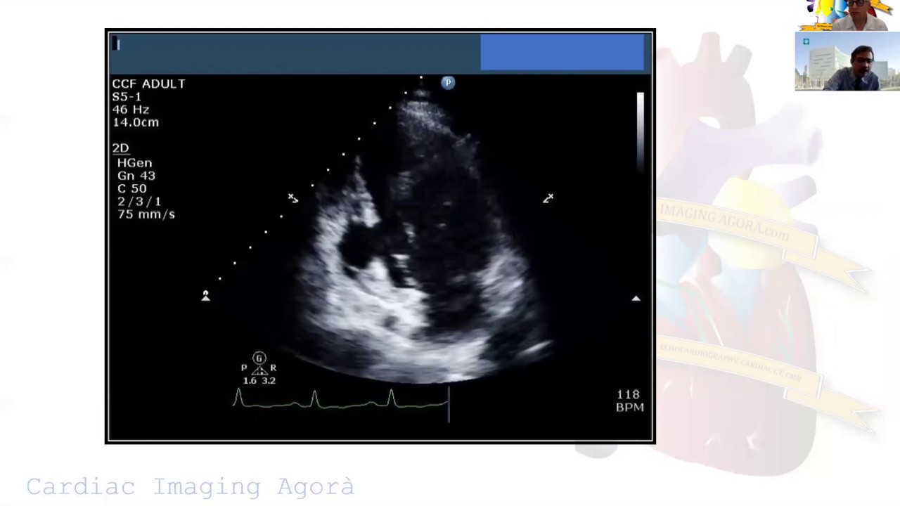 Echocardiography in identifying mechanical complications of myocardial ...