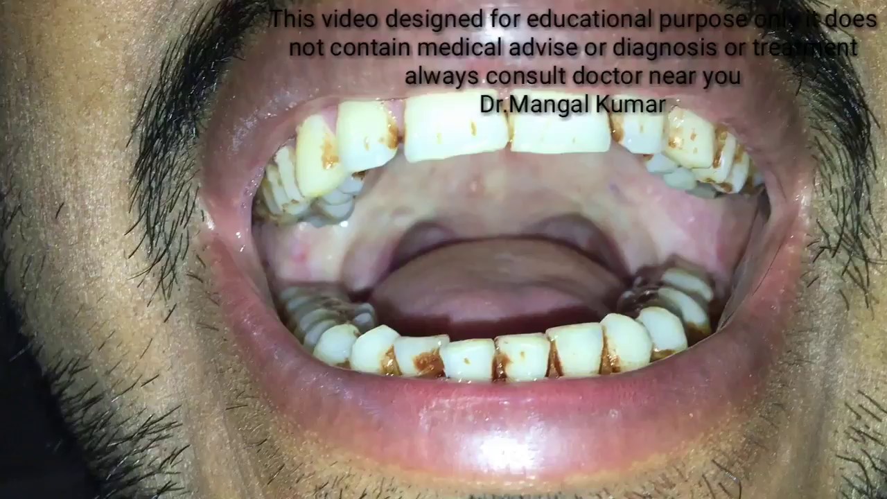 Oral submucous fibrosis (OSMF) clinical feature & Treatment - YouTube