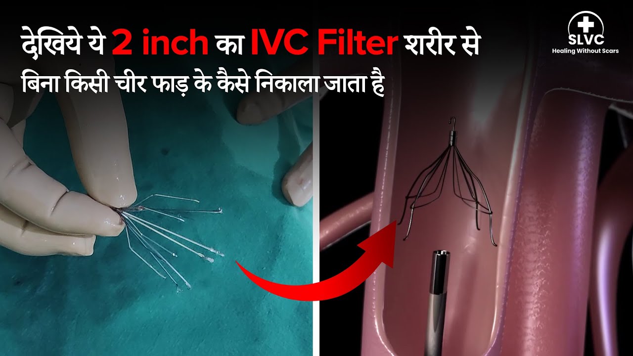 IVC Filter: Lifesaver or Risk? Why is it Removed? - YouTube