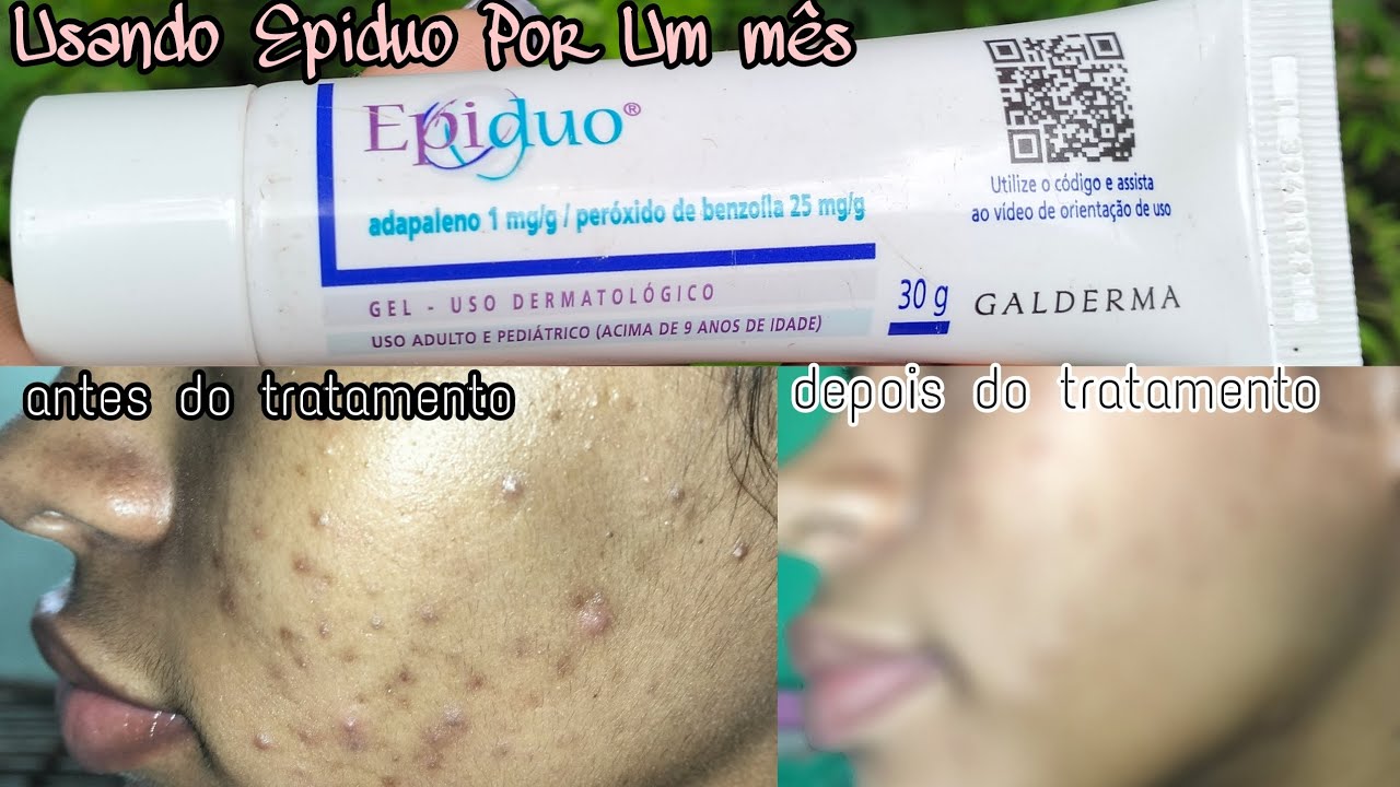 Usei Epiduo por um mês para cravos e espinhas vem conferir - YouTube